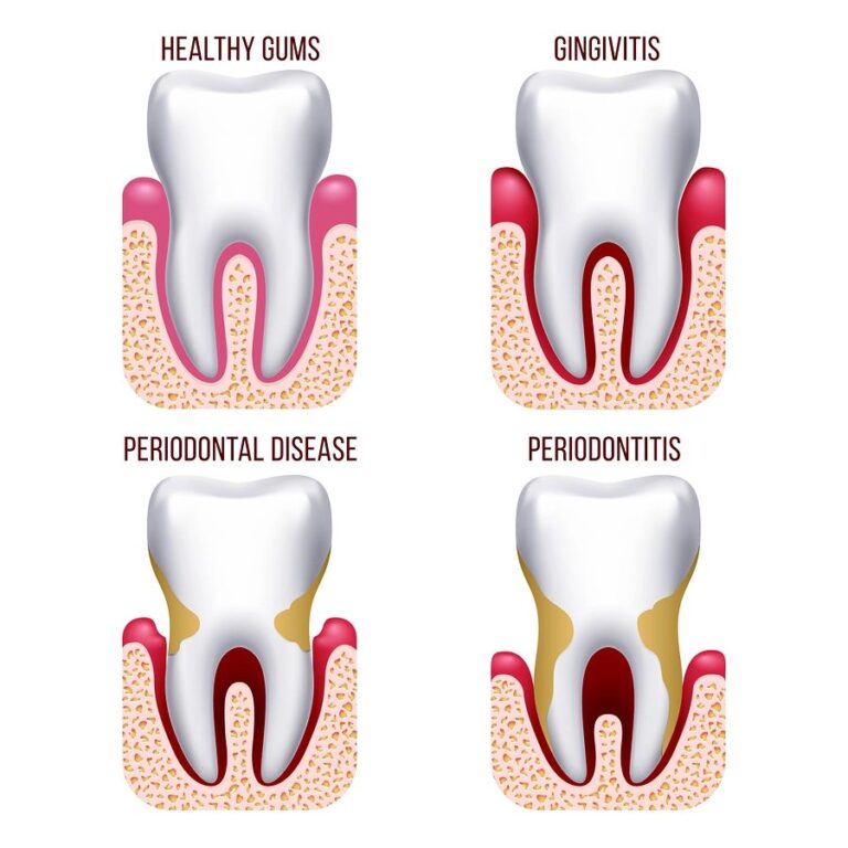 6 tips on What you Should About Dental Periodontal Pockets