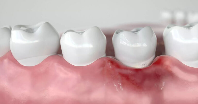 Is there a possible Link Between Periodontal Disease and Cancer?